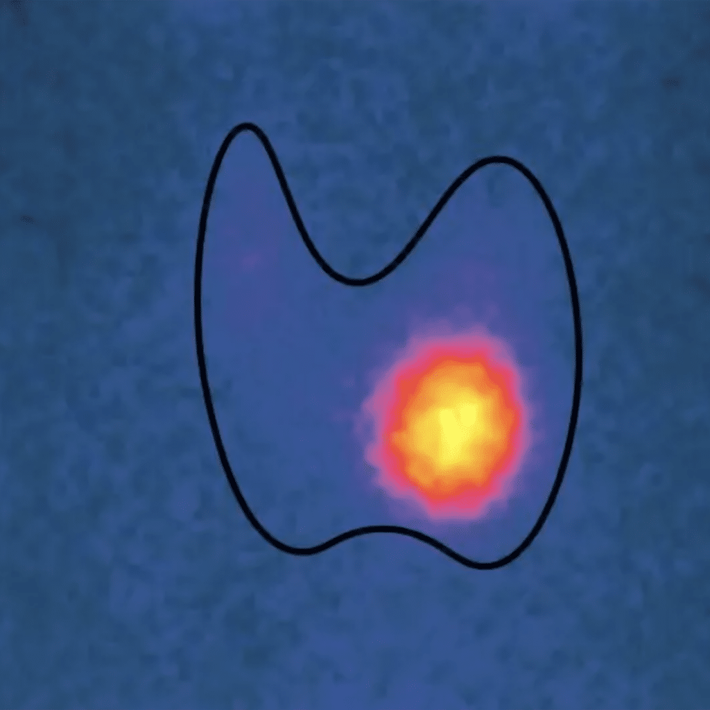 Szintigrafie der Schilddrüse | Untersuchung Schilddrüsenknoten