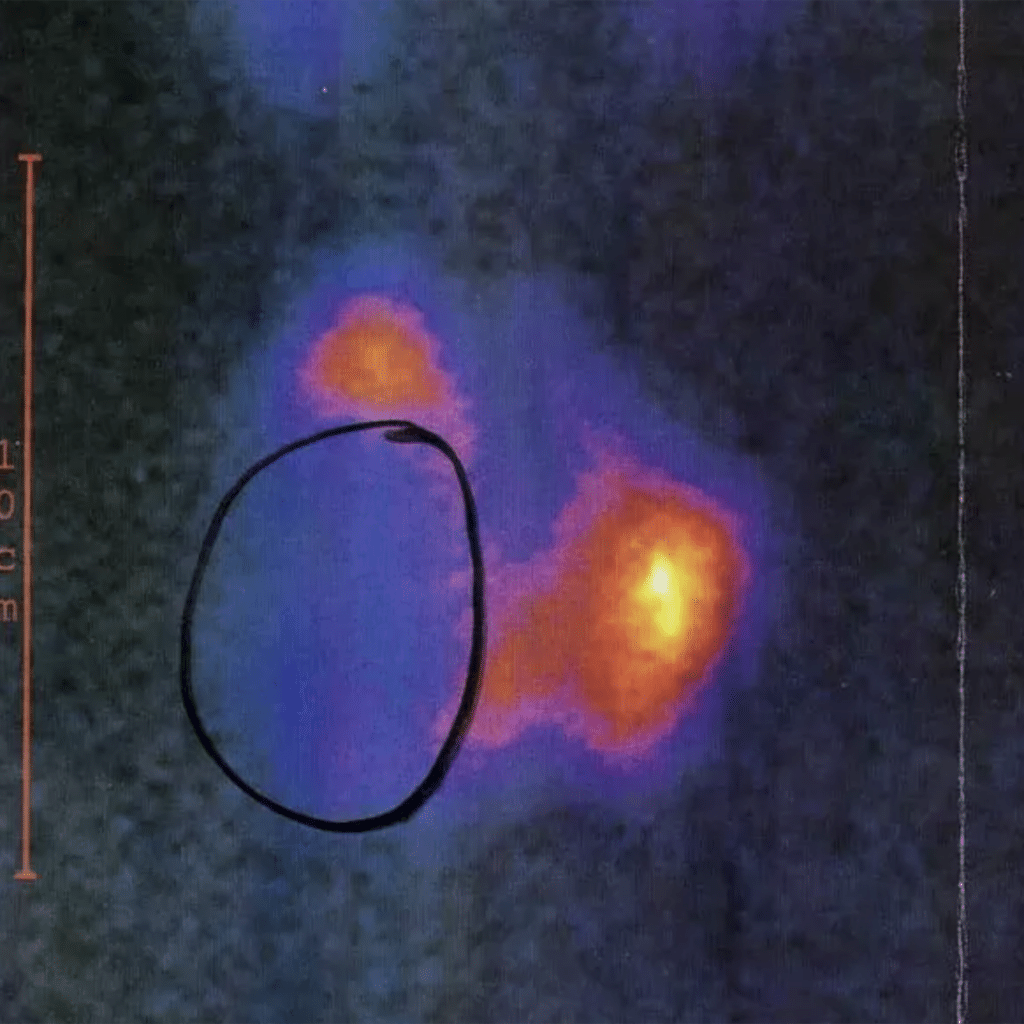 Szintigrafie der Schilddrüse | Untersuchung Schilddrüsenknoten