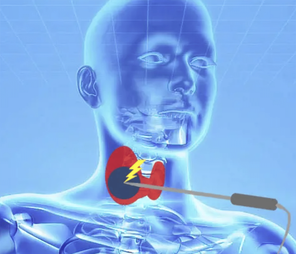 Thermoablation | Nicht-operative Behandlung Schilddrüsenknoten