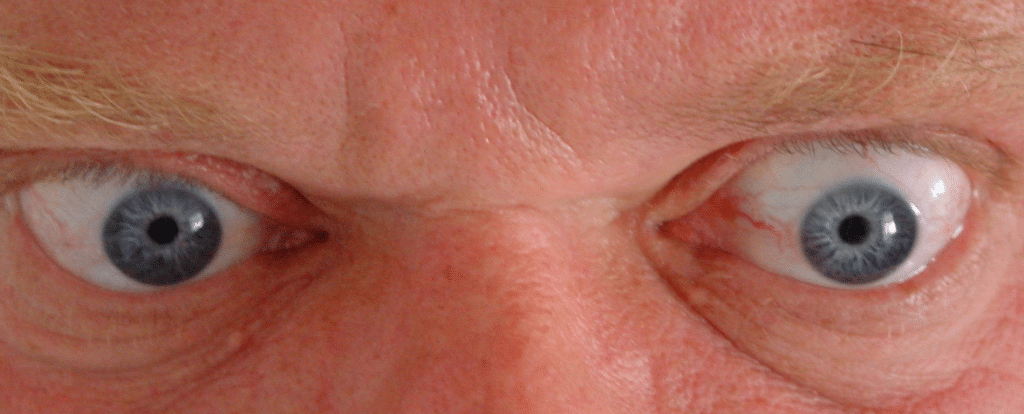 Diagnostik und Therapie des Morbus Basedow | Prof. Zieren